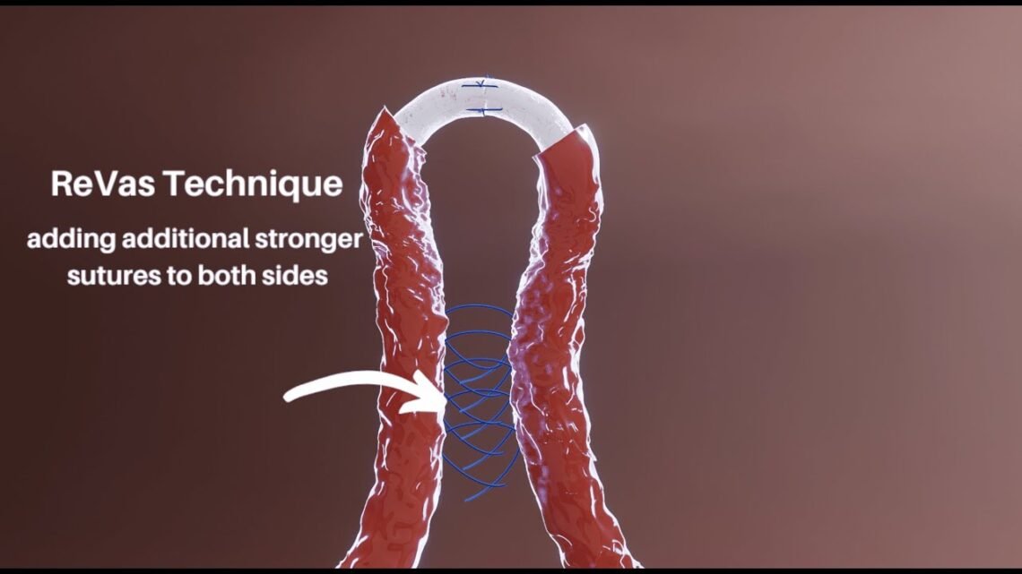 How Can You Reverse a Vasectomy? - RedGIF